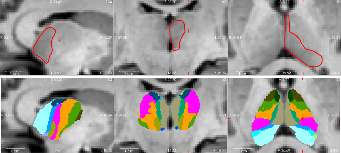 Creating anatomical masks with Freesurfer – neuroBren